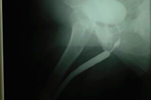 Bulbar Strictures | World-Renowned Specialist