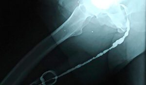 Lichen Sclerosus – Balanitis Xerotica Obliterans – BXO | World-Renowned ...