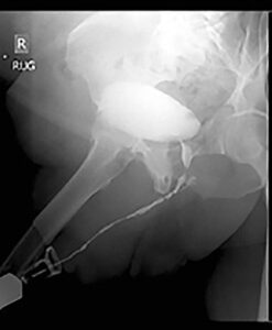 Lichen Sclerosus – Balanitis Xerotica Obliterans – BXO | World-Renowned ...