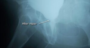 Bladder Neck ContracturesCenter for Reconstructive Urology