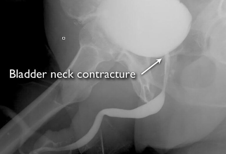Bladder Neck ContracturesCenter for Reconstructive Urology