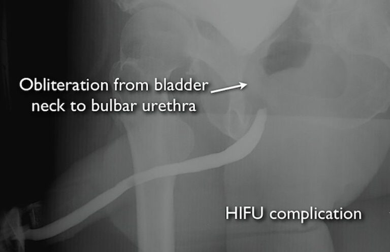 Bladder Neck Contracturescenter For Reconstructive Urology