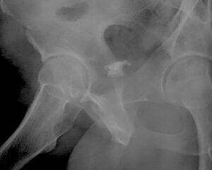 Causes & Symptoms Of Urethral Strictures | World-Renowned Specialist