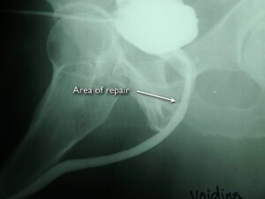 Urethral Stricture - Center for Reconstructive Urology