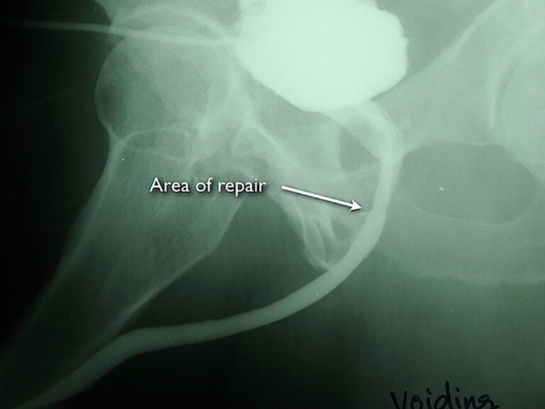 Urethral Stricture - Center for Reconstructive Urology