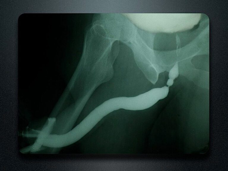 Urethral Stricture Diagnostic Evaluation | World-Renowned Specialist