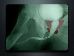 Urethral Stricture Diagnostic Evaluation | World-Renowned Specialist