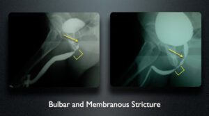 Urethral Stricture Diagnostic Evaluation | World-Renowned Specialist