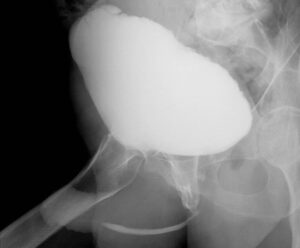 Causes & Symptoms Of Urethral Strictures | World-Renowned Specialist