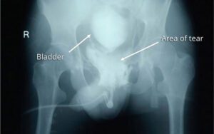 Pelvic Fracture Urethral Injury | World-Renowned Specialist