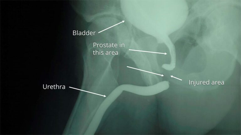 Pelvic Fracture Urethral Injury | World-Renowned Specialist