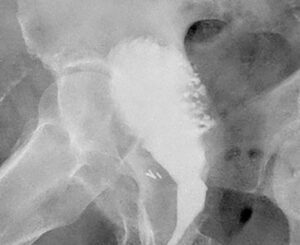 Causes & Symptoms Of Urethral Strictures | World-Renowned Specialist