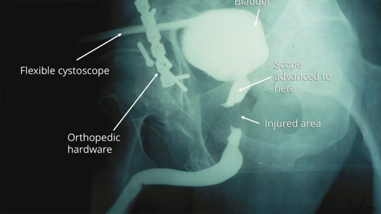 Pelvic Fracture Urethral Injury | World-Renowned Specialist